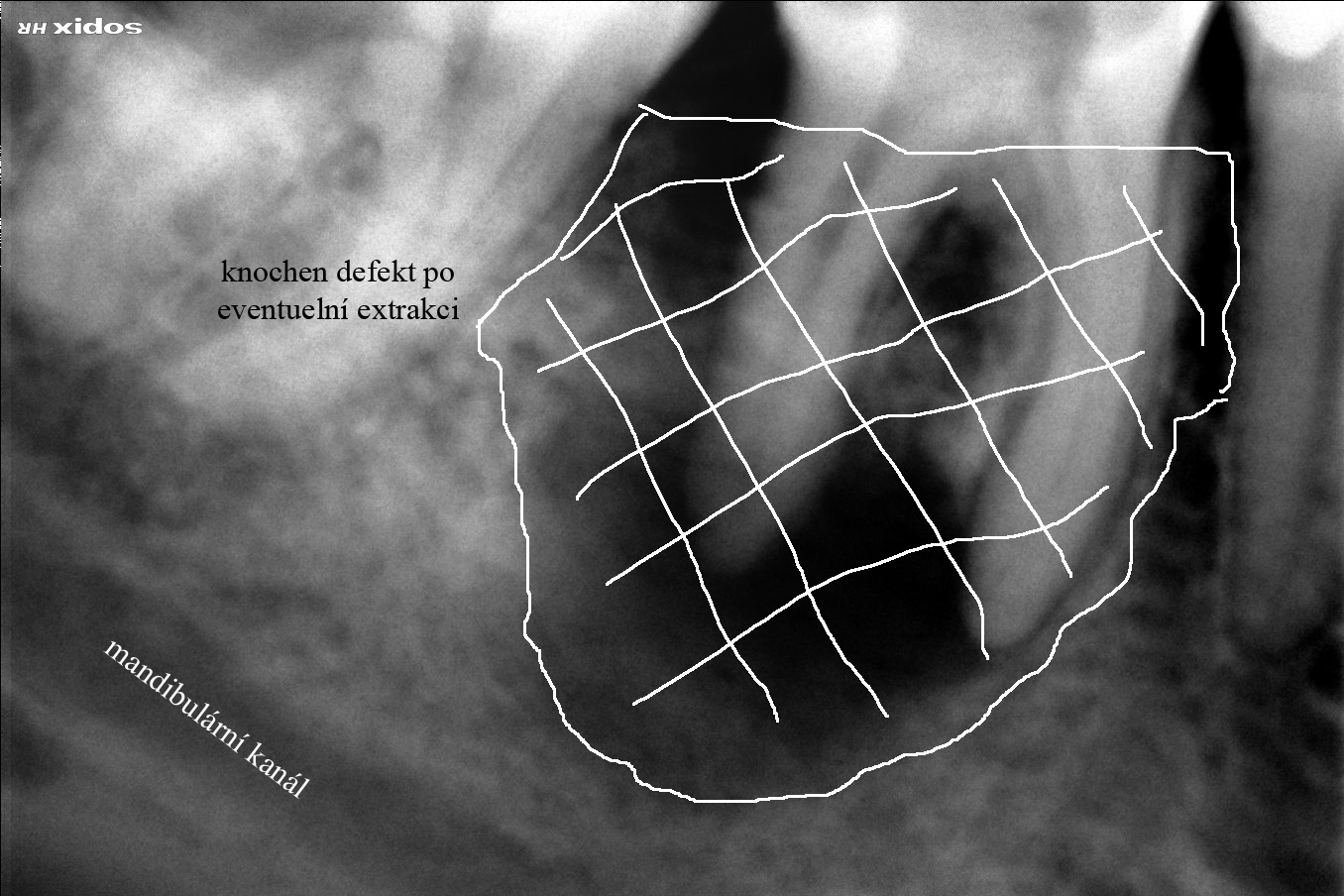 Augmentation | Zubní Ordinace Praha 10
